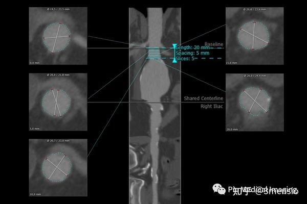 3mensio vascular - 知乎