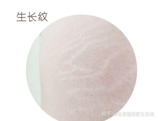 怎么区分生长纹和妊娠纹 知乎