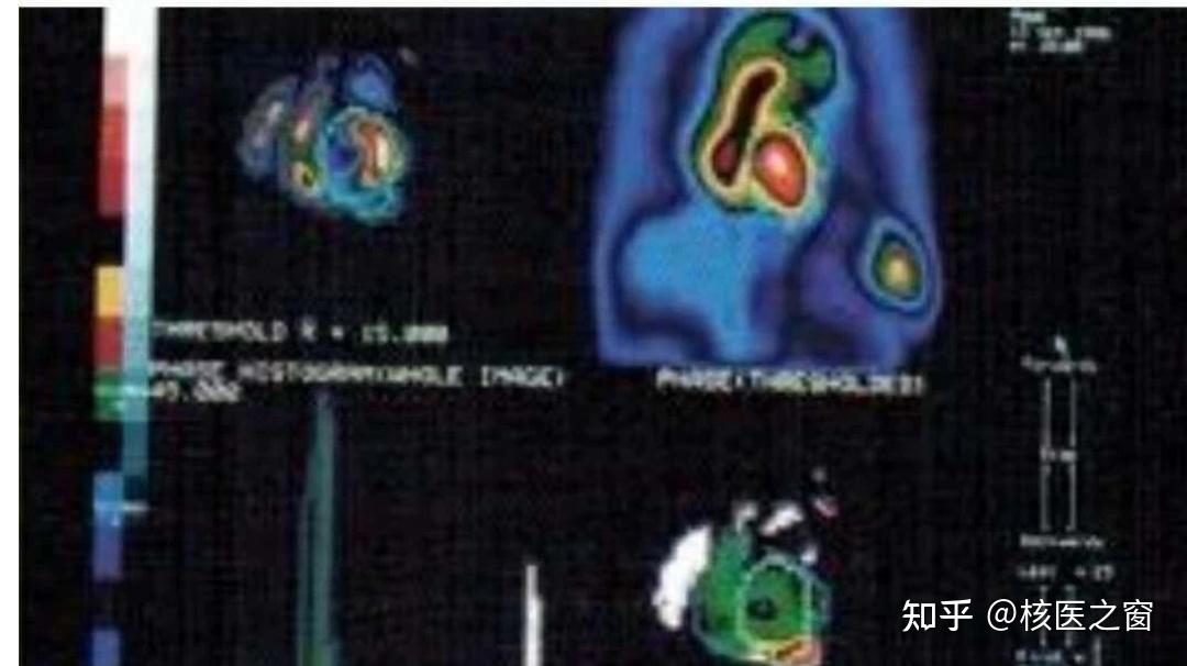 SPECT显像主要检查项目都有哪些? - 知乎