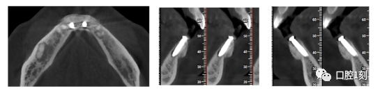 Sticky Bone在引导骨再生中的应用 - 知乎