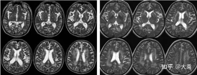 脑白质病变-Fazekas分级简介 - 知乎