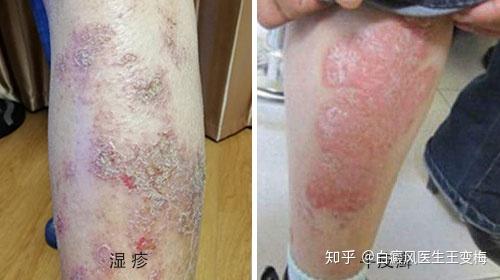 牛皮癣和湿疹是一回事吗?怎么来区分呢 知乎