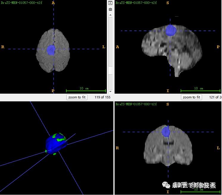 BraTS2023-MEN——BraTS2023颅内脑膜瘤分割挑战赛 - 知乎