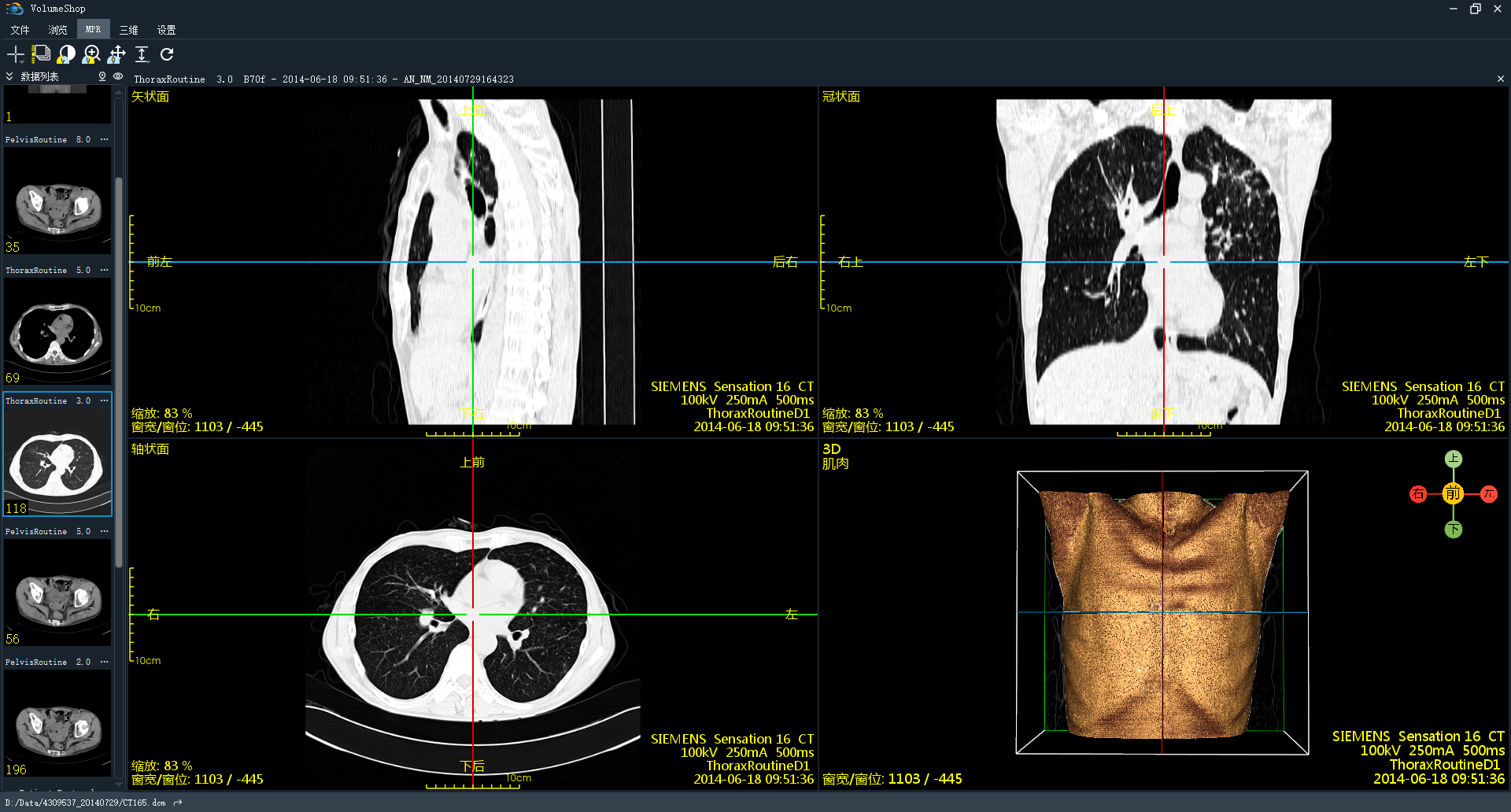 医学影像MPR（多平面重建）介绍 - 知乎