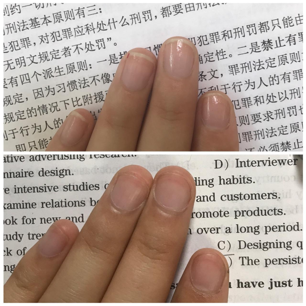 从小开始咬指甲 以至于现在甲床很小 留起来指甲也是往外翻 很难看 想通过做美甲来改变不知道可不可以 ? 知乎