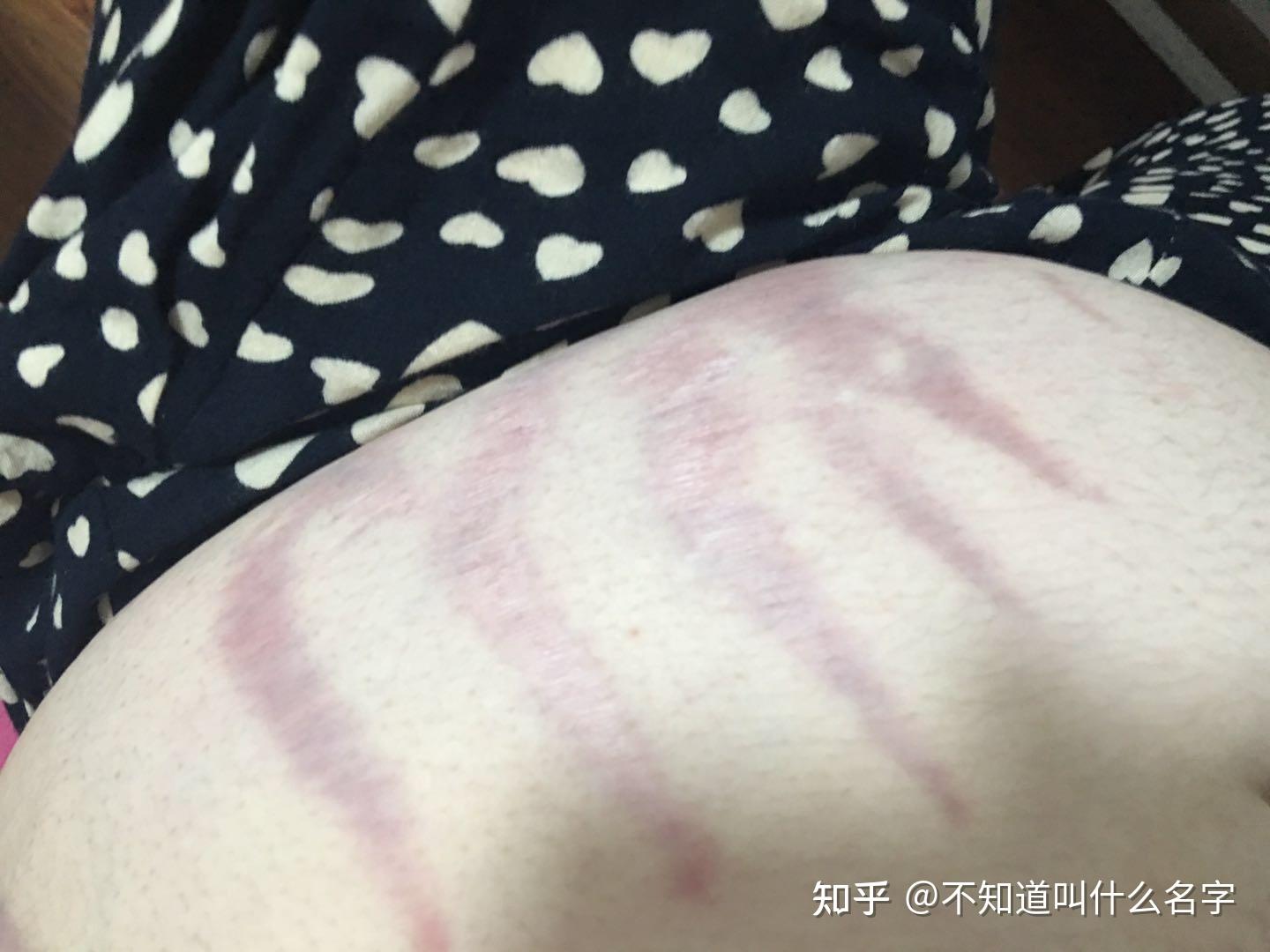 7年了,我的激素纹(肥胖纹)终于离我而去了 知乎