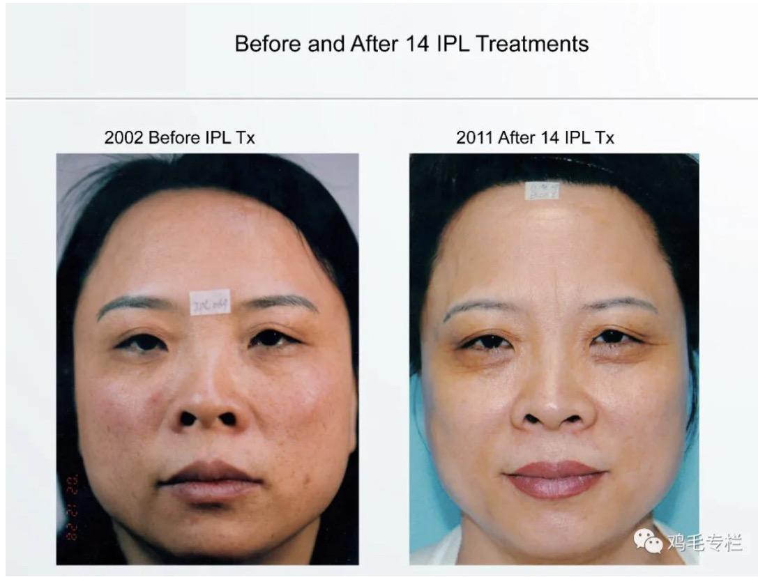 光子嫩肤最全科普，别再IPL OPT AOPT BBL ICON傻傻分不清楚了！ - 知乎