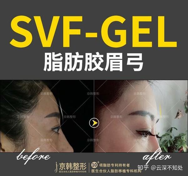 SVF脂肪胶 - 知乎