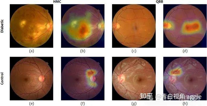 Nature子刊 |DiaNet v2：使用视网膜成像诊断糖尿病的突破性飞跃 - 知乎