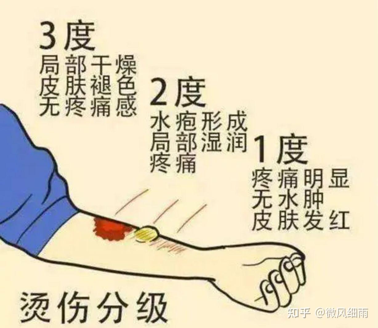 被热液烫伤了该怎么办呢？ - 知乎