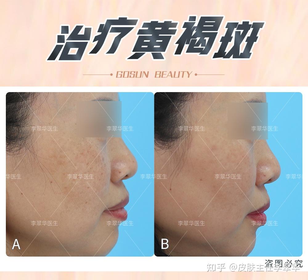 治疗黄褐斑用氢醌乳膏副作用大么? - 知乎