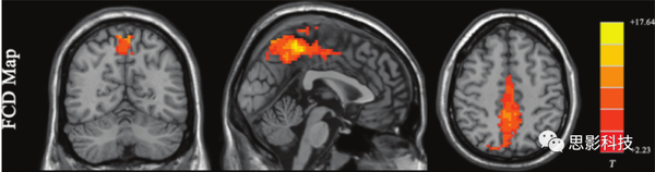 功能性核磁共振成像--知识点汇总 - 知乎