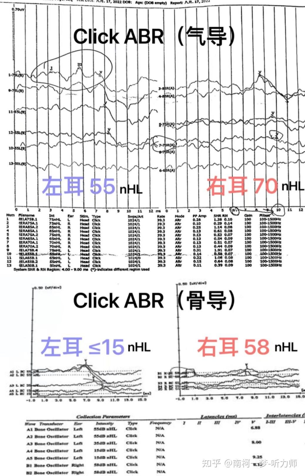 案例分享|外中耳(小耳)畸形双模干预 - 知乎