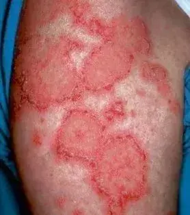 从 2017 年 SLE 新标准来说说 SLE 认识演变史 - 知乎