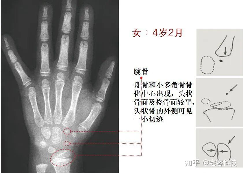 儿童生长发育骨龄图谱丨建议收藏！ - 知乎