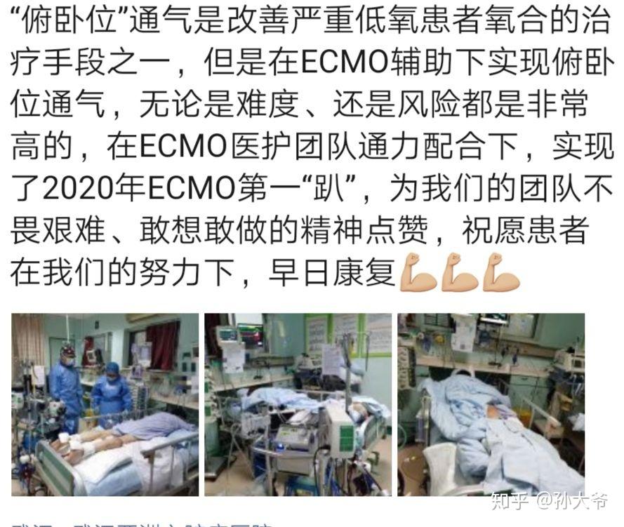 来吧，写个给普通人看的ECMO介绍 - 知乎