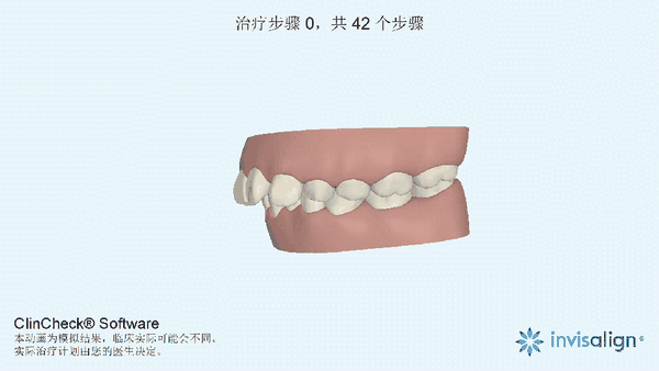 入选Invisalign Global Gallery | 上颌前突+下颌后缩青少年不拔牙隐形矫正，让脸型“变小”！ - 知乎