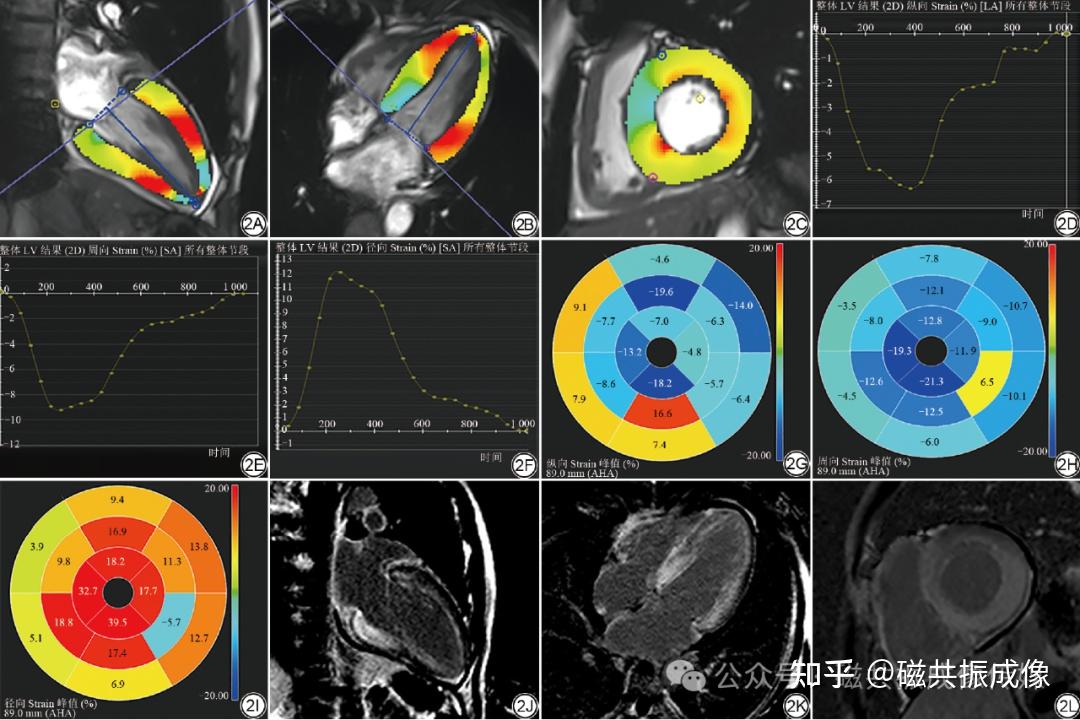 封面文章：CMR特征追踪成像在鉴别心脏淀粉样变性亚型中的研究 - 知乎
