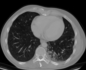 Chest CT-Scan images 数据集介绍 - 知乎