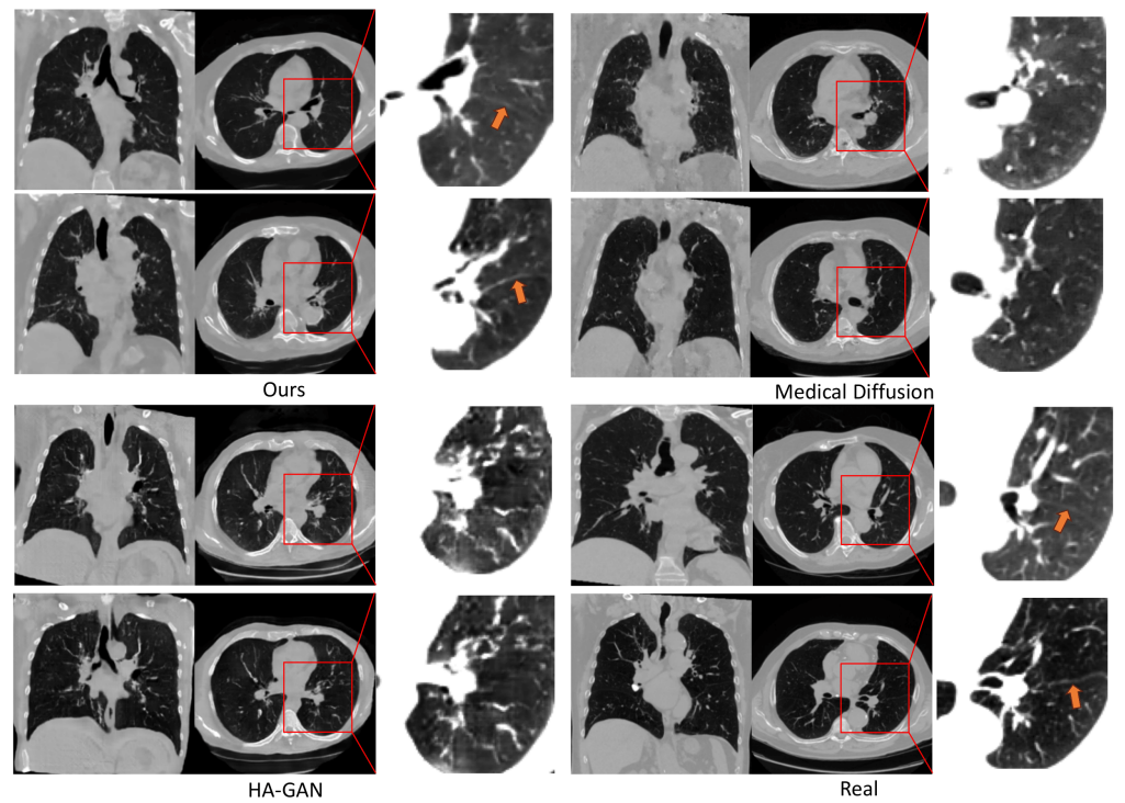 医学生成模型MedSyn：文字引导，AI“画”出高保真CT图像 - 知乎