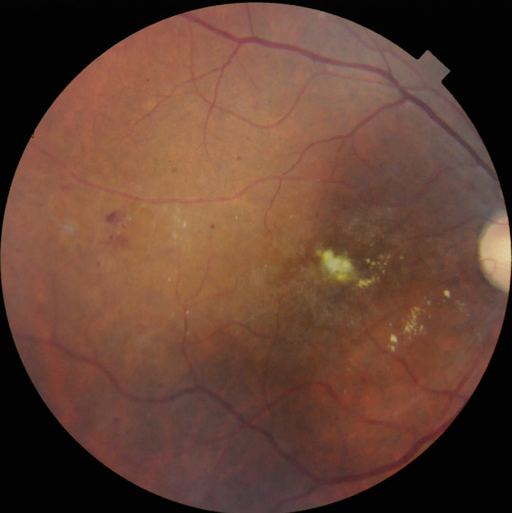 Multi-Label Retinal Diseases视网膜眼底图像分类数据集介绍 - 知乎