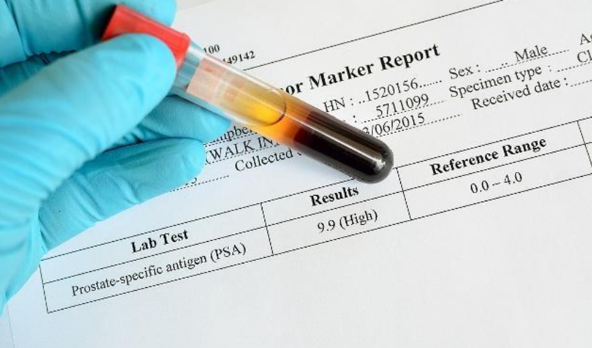 为什么要检查PSA？教你解读PSA数值 - 知乎