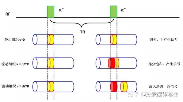 磁共振血管成像技术——流入增强TOF技术 - 知乎
