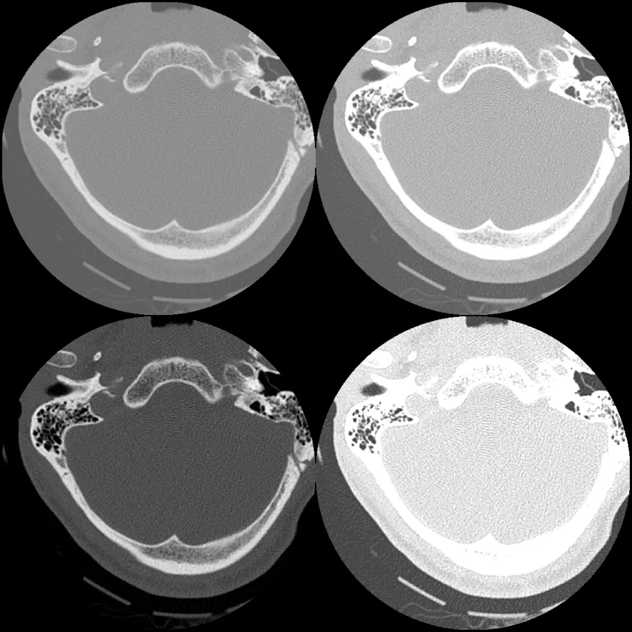 CT-Windowing医学CT图像增强 - 知乎