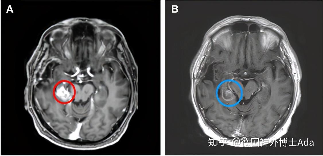 胶质母细胞瘤目前有哪些新疗法？简单盘点7大前沿治疗 - 知乎