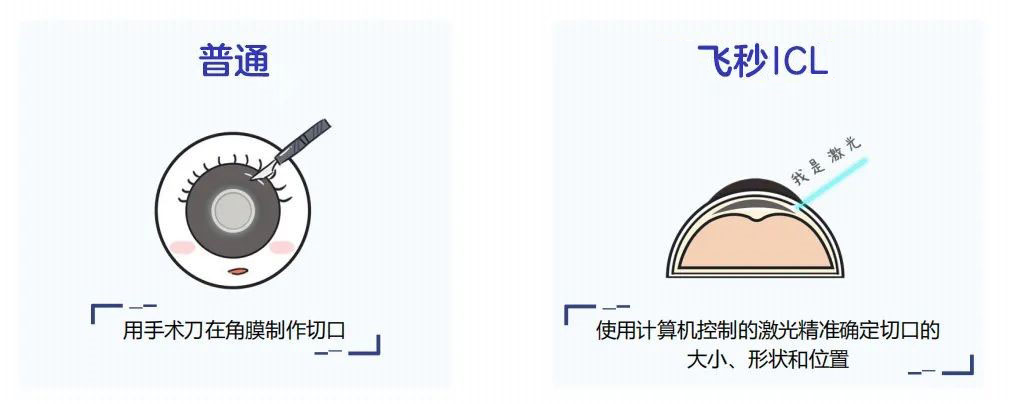 解密I 飞秒ICL和ICL晶体植入的区别 - 知乎