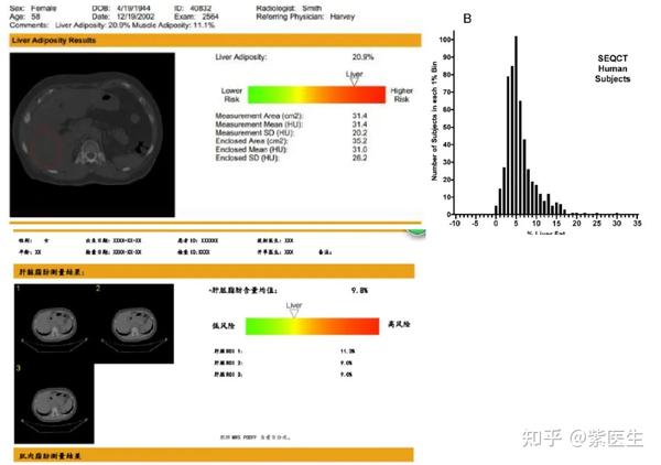 定量CT（QCT）是什么？临床应用有哪些？ - 知乎