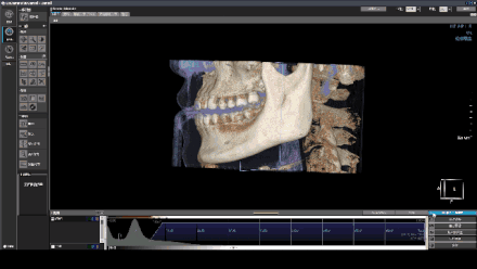 什么是口腔CBCT，种牙为什么要拍CBCT片？ - 知乎