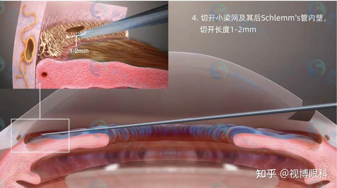 图解： iTrack 内路粘小管成形术（ABiC），一种微创高效的青光眼手术 - 知乎