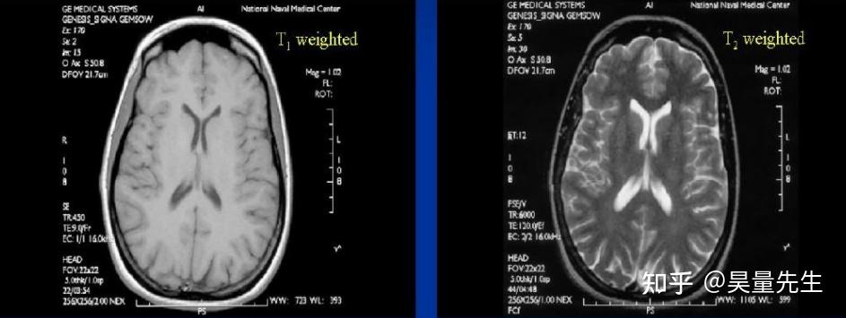 深入浅出带你了解磁共振成像（MRI）基本原理 - 知乎