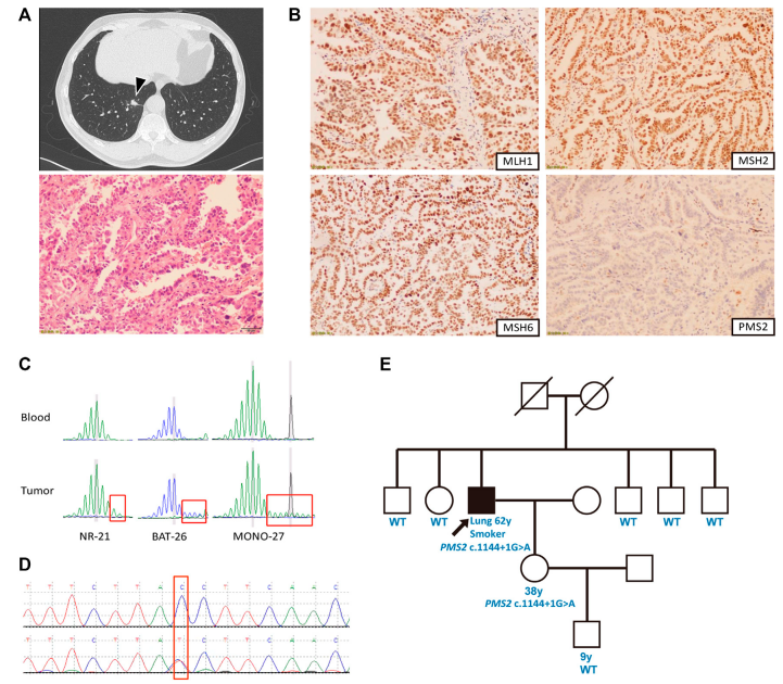 学术前沿丨MSI-H在肺癌中的相关探索 - 知乎