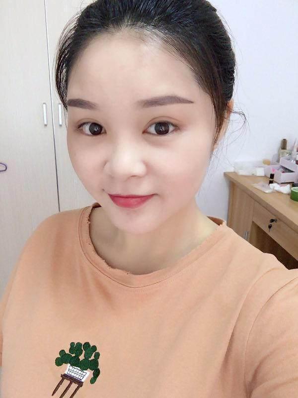 【案例】全切双眼皮：路人大饼脸变可爱萝莉妹 知乎