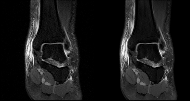 RaDynMR加速膝关节MRI扫描 - 知乎