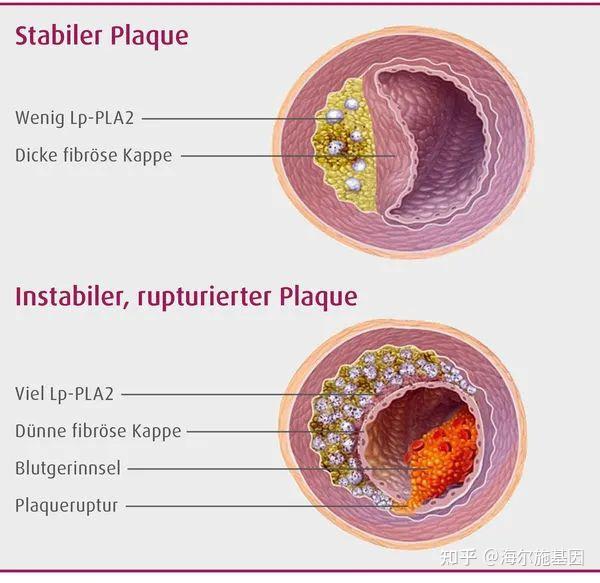 心脑血管疾病的“指南针”——脂蛋白相关磷脂酶A2(Lp-PLA2) - 知乎