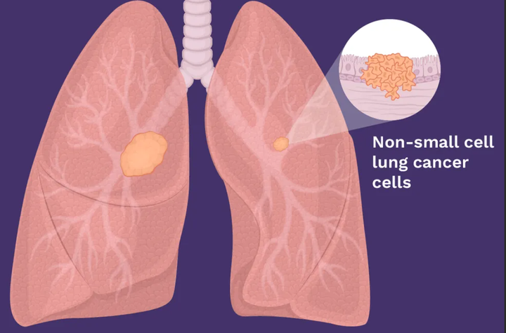 全球首个TROP 2靶向肺癌ADC疗法获批！第一三共DATROWAY®在美斩获新适应症！可线上预约用药咨询。 - 知乎