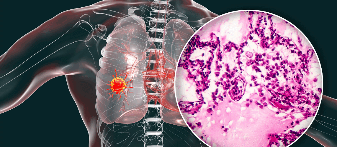 FoundationOne®Liquid CDx与特泊替尼助力肺癌诊疗，一线治疗优势明显但不良反应需留意 - 知乎