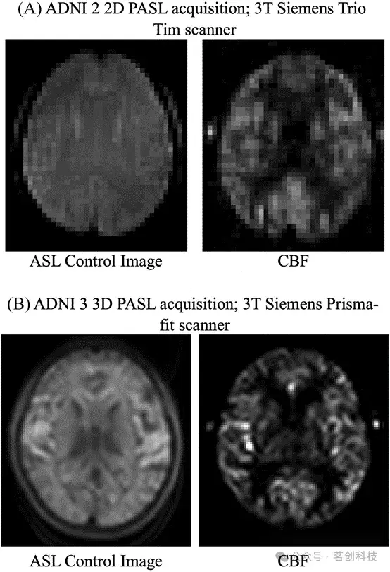 Alzheimer’s & Dementia | 阿尔茨海默病神经影像学倡议(ADNI)中的动脉自旋标记灌注MRI - 知乎