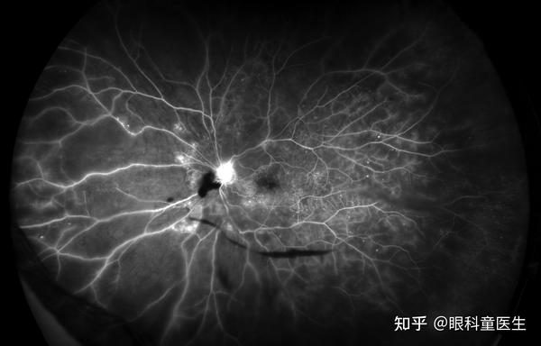 眼底彩照和眼底造影阅片 - 知乎