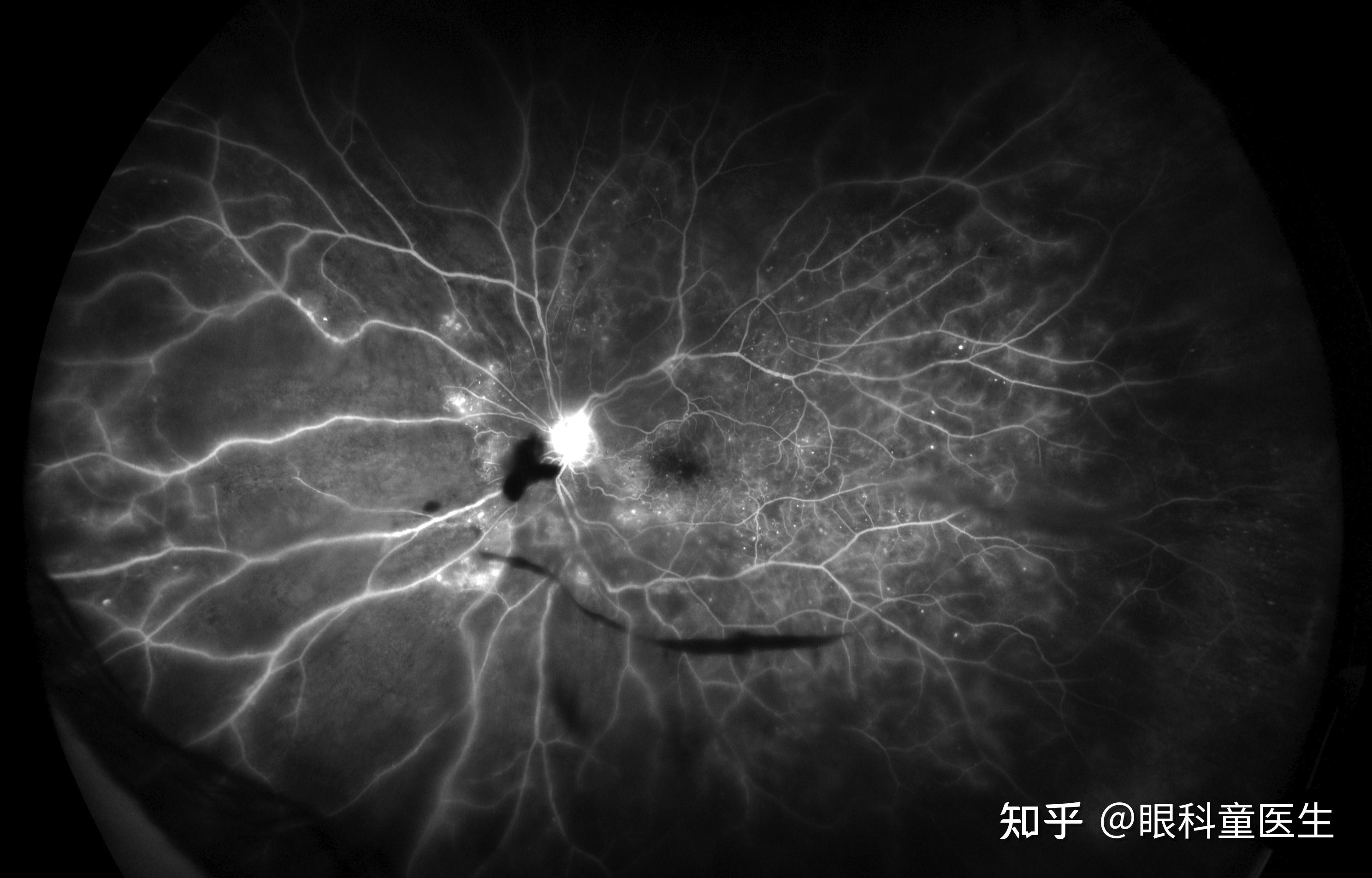 眼底彩照和眼底造影阅片 - 知乎
