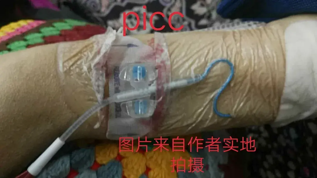 化疗选择picc还是输液港 - 知乎
