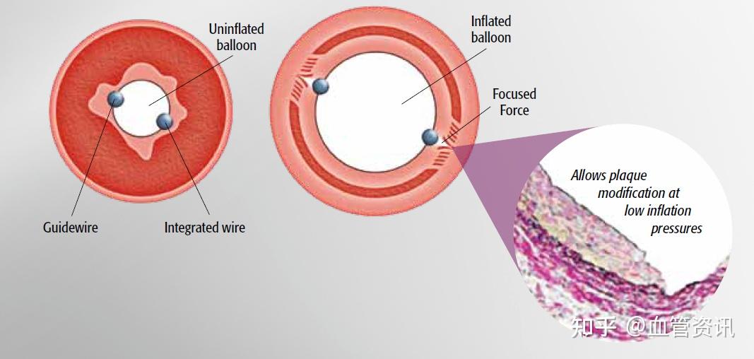 双导丝球囊之四两拨千斤 - 知乎
