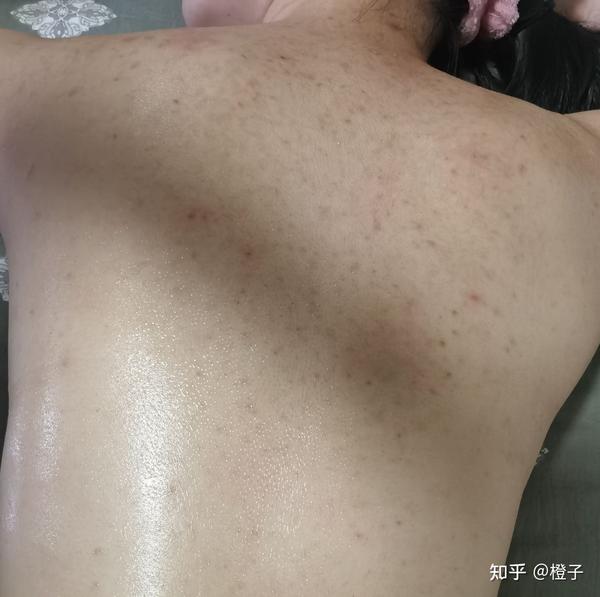 如何去背部痘痘及痘印 知乎