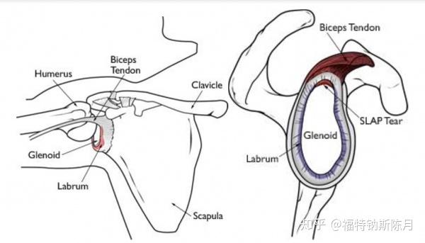 什么是SLAP损伤 - 知乎