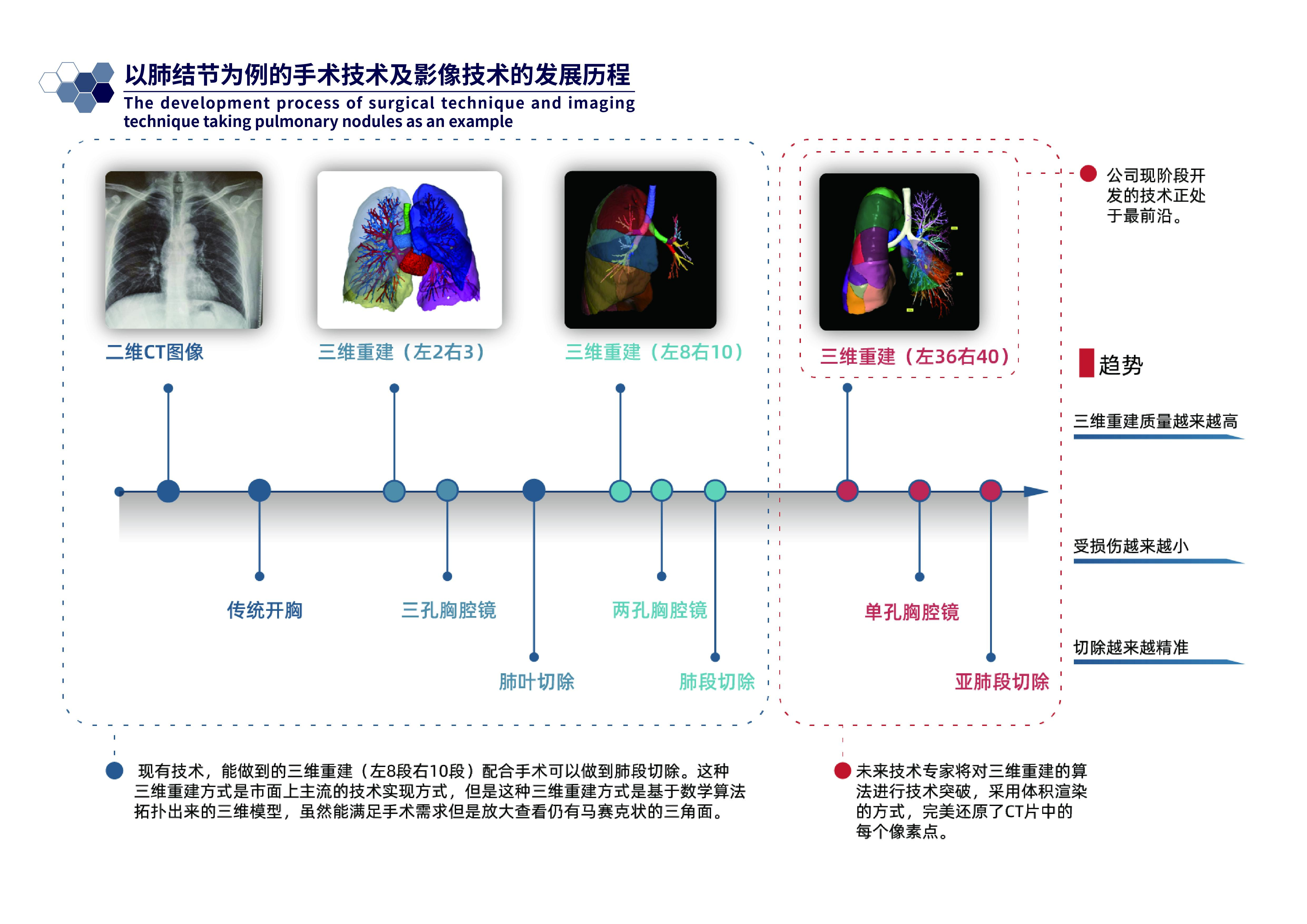 精准医疗——肺结节切除手术 - 知乎