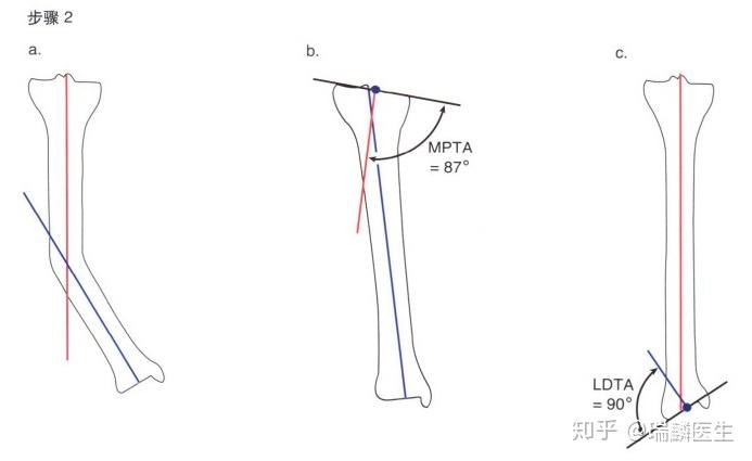 《矫形外科原则》读书笔记（二）-胫骨机械轴及解剖轴分析 - 知乎
