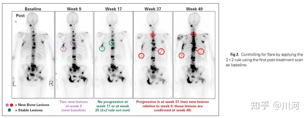 临床试验-肿瘤：PCWG3 中文版 (v1.1 by Jihai/SAS茶谈) - 知乎
